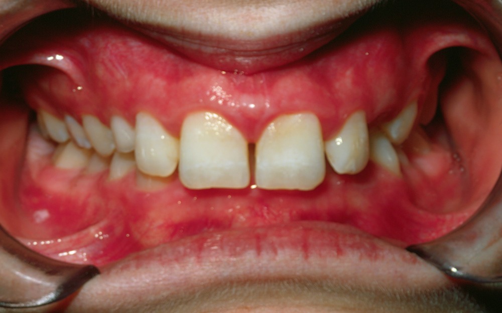 Orthodontic Before & Afters | Kingwood Braces | Invisalign Kingwood