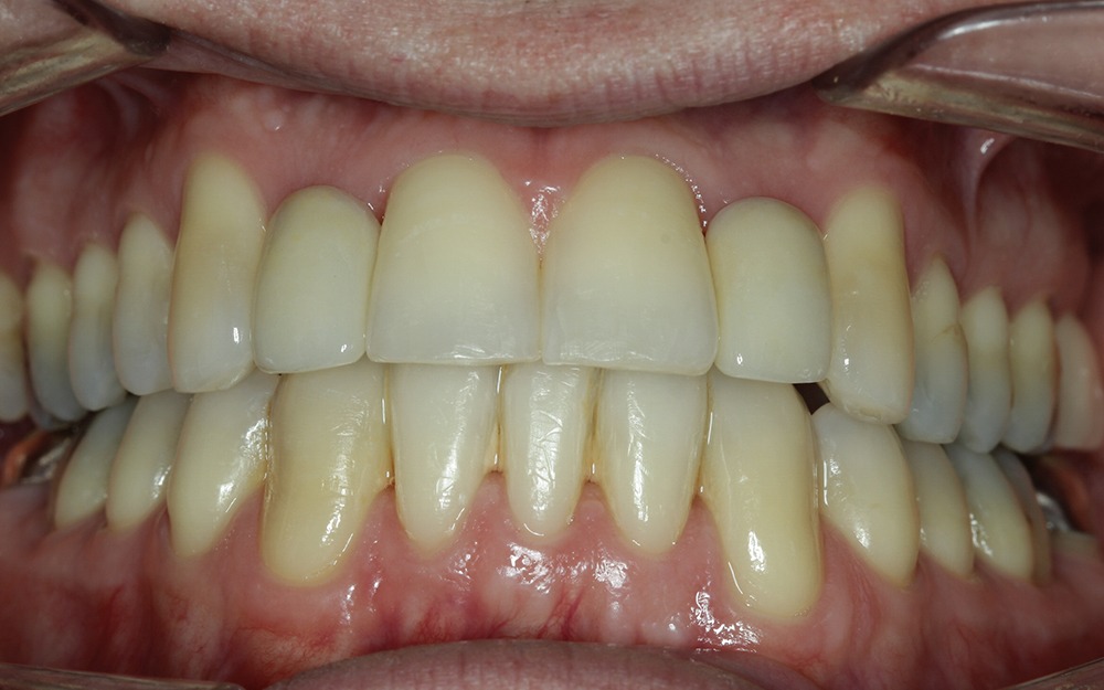 Orthodontic Before & Afters | Kingwood Braces | Invisalign Kingwood