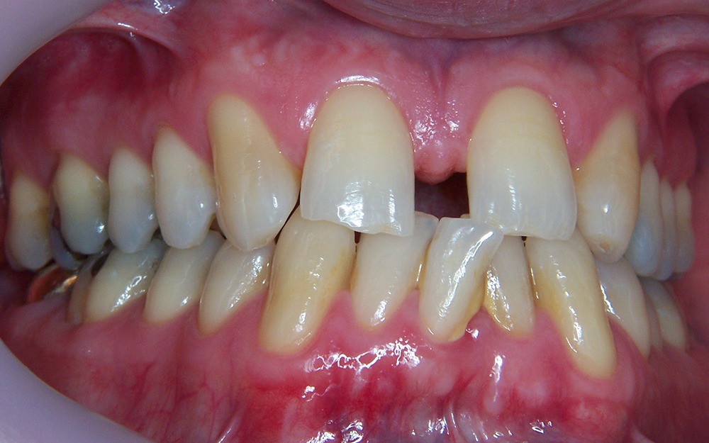 Orthodontic Before & Afters | Kingwood Braces | Invisalign Kingwood