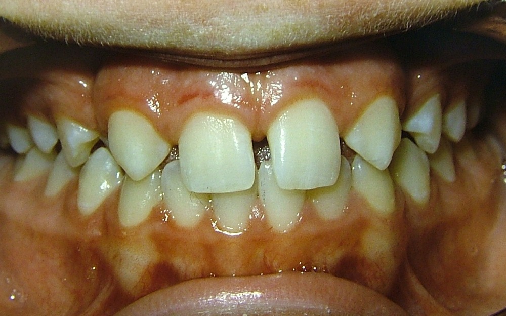 Orthodontic Before & Afters | Kingwood Braces | Invisalign Kingwood